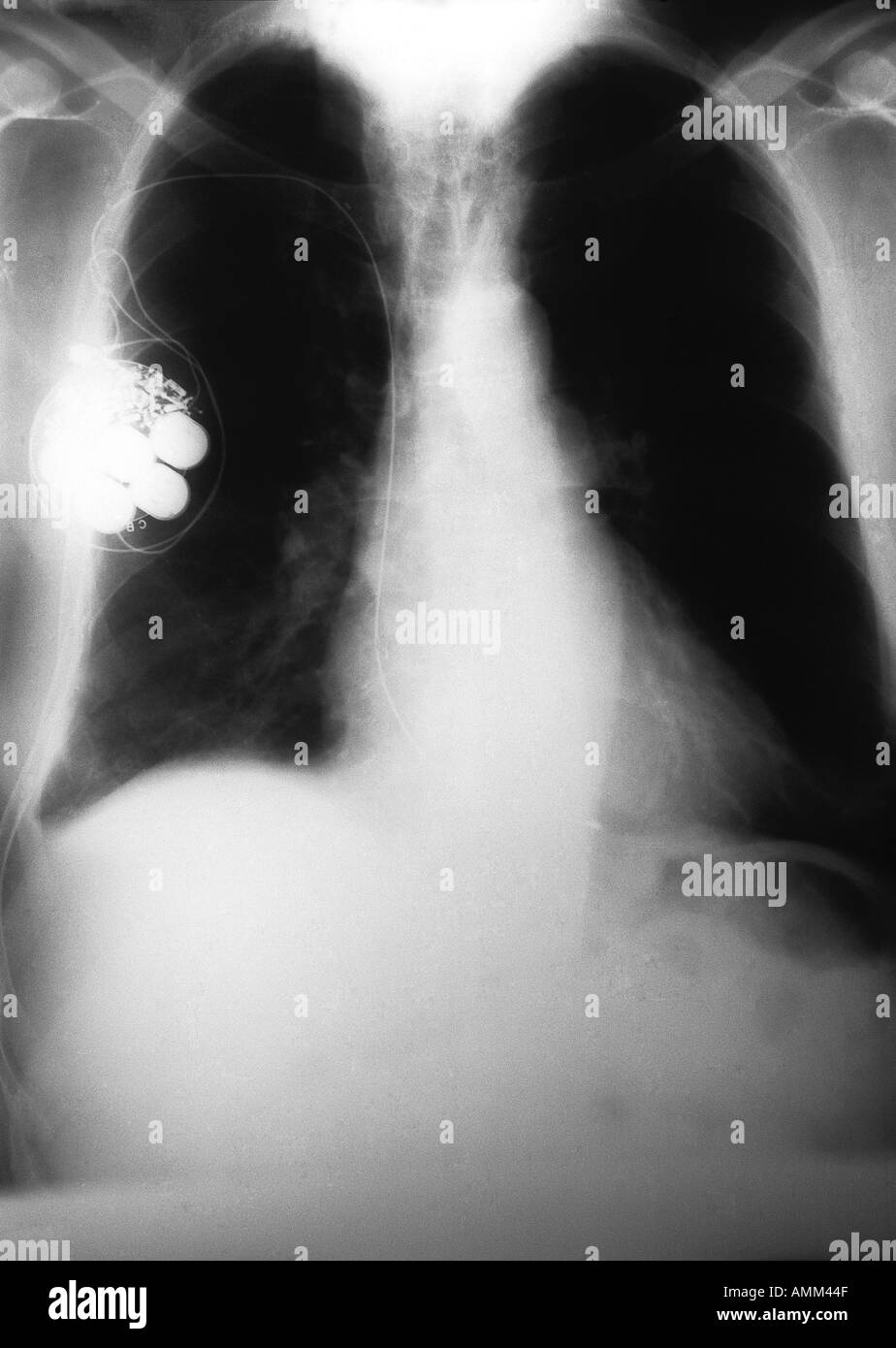 Chest x ray cardiac pacemaker in situ Stock Photo - Alamy