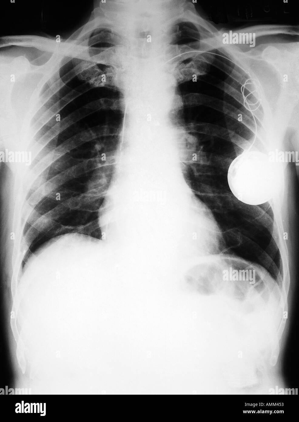 Chest x ray cardiac pacemaker in situ Stock Photo - Alamy