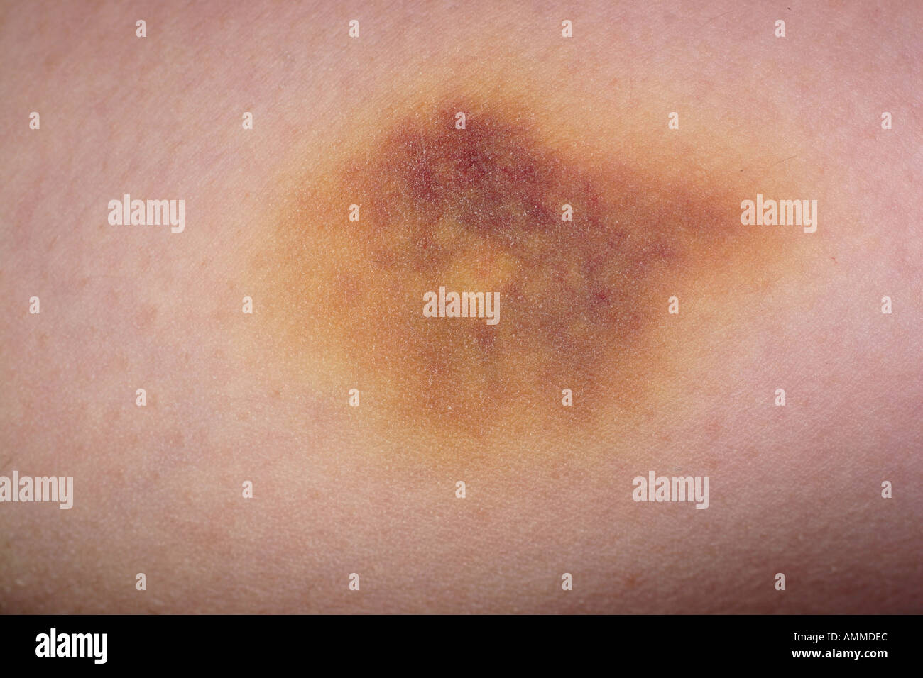 Skin contusion hi-res stock photography and images - Alamy