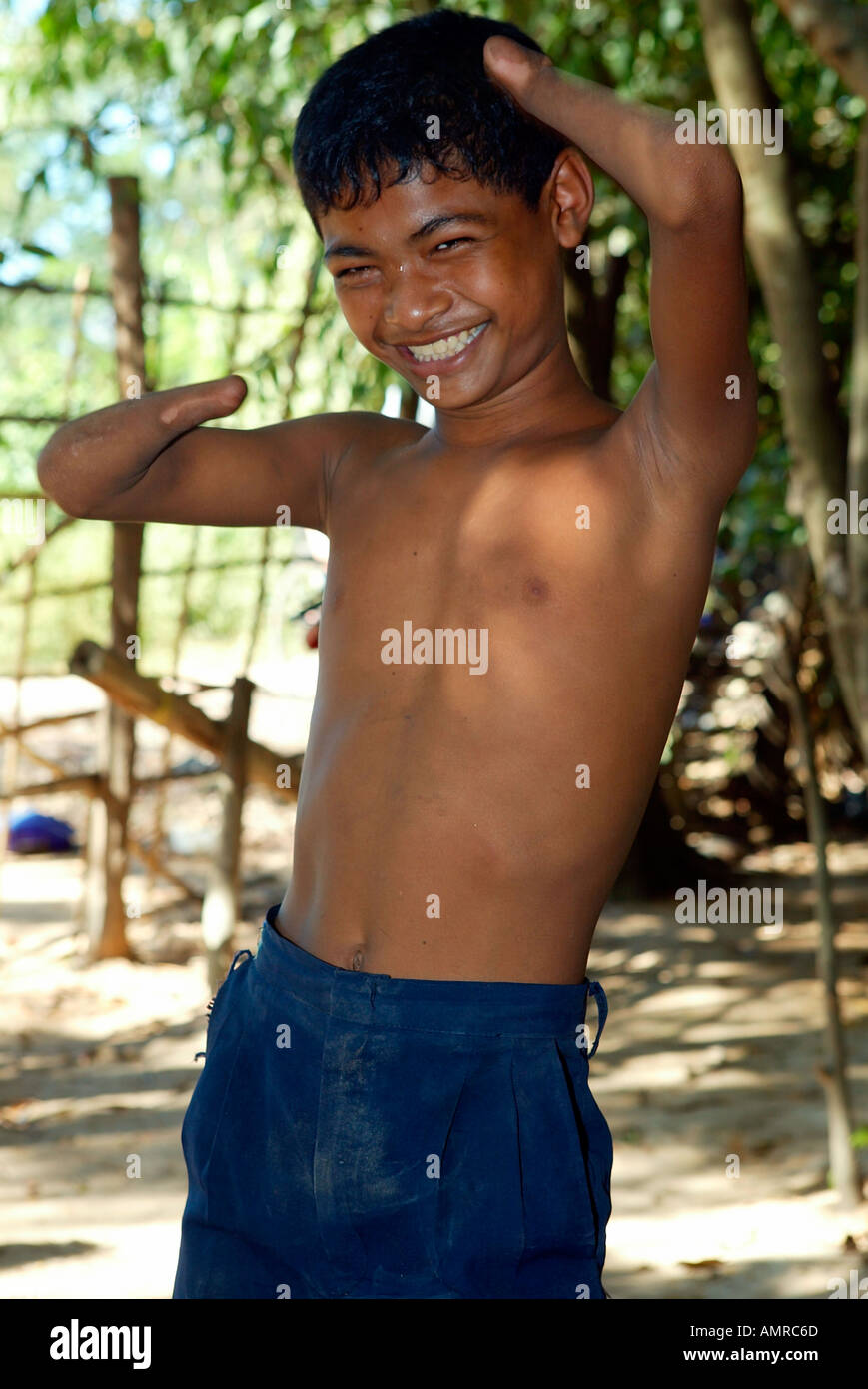 Landmine blast victim aged 12 has no hands rehabilitation centre in ...