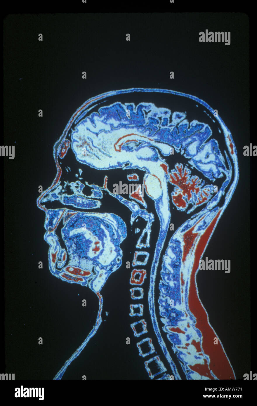 Brain Scan MRI Stock Photo - Alamy