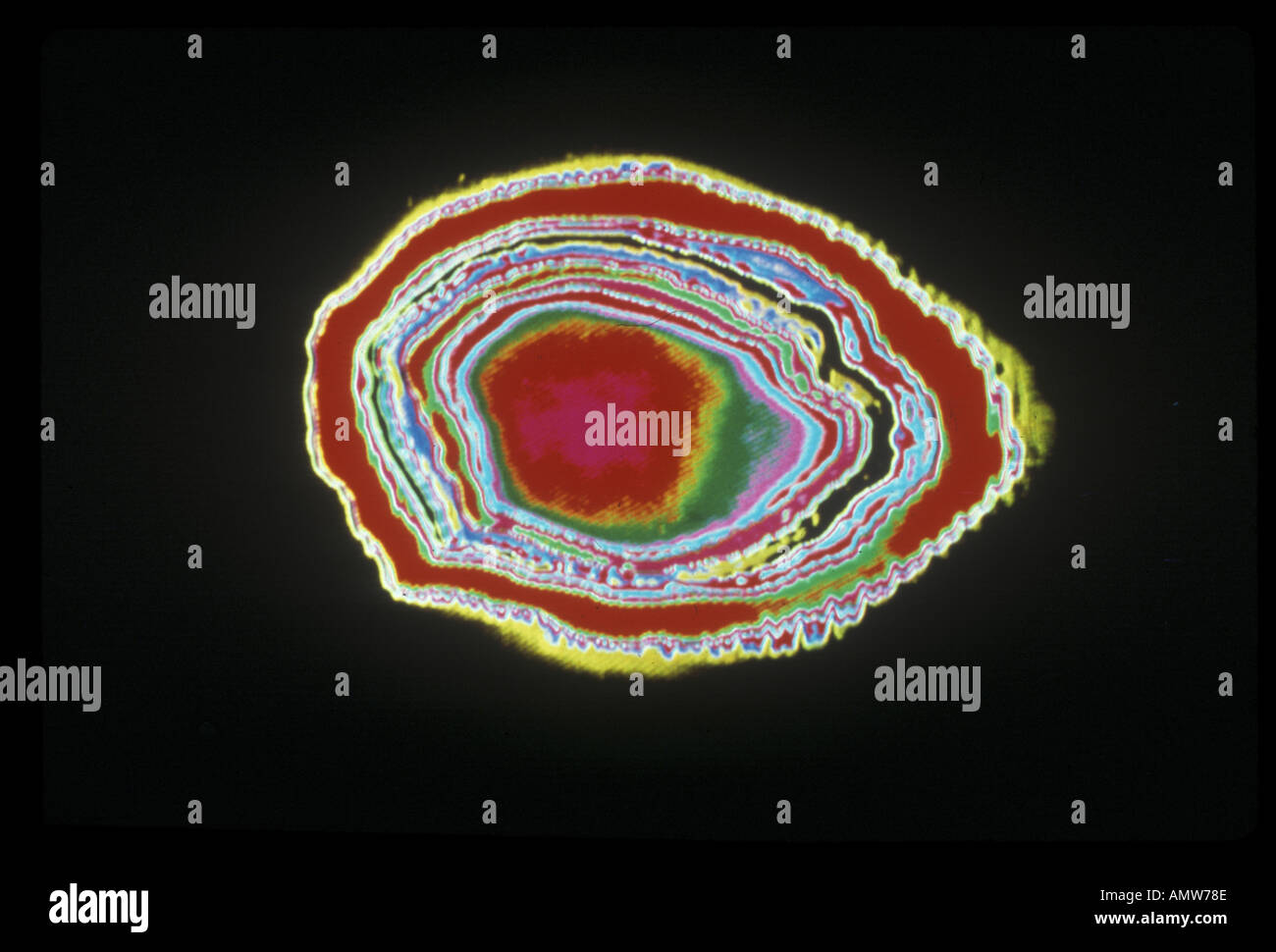 Occluded artery hi-res stock photography and images - Alamy
