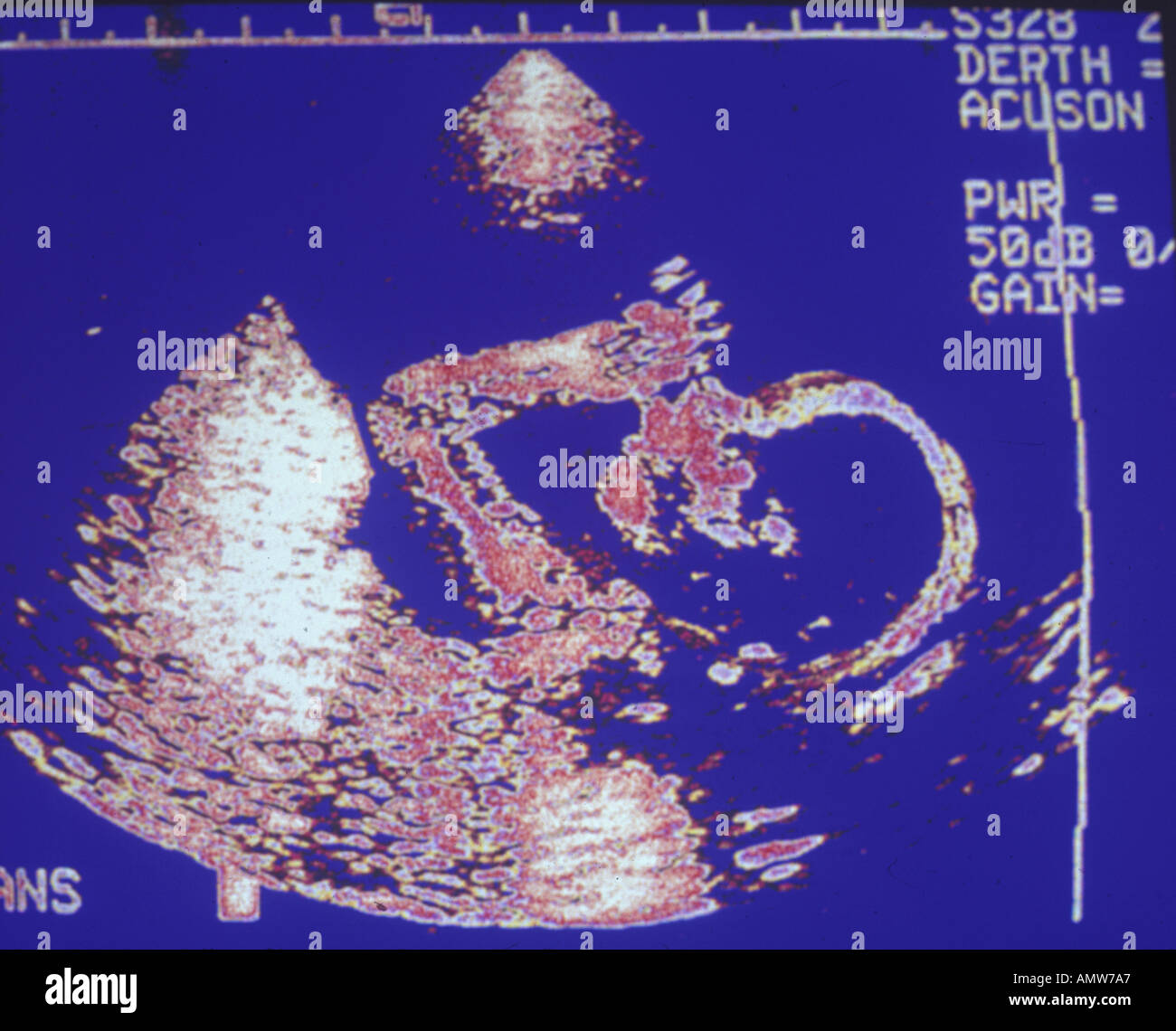 Fetus 22 weeks hi-res stock photography and images - Alamy