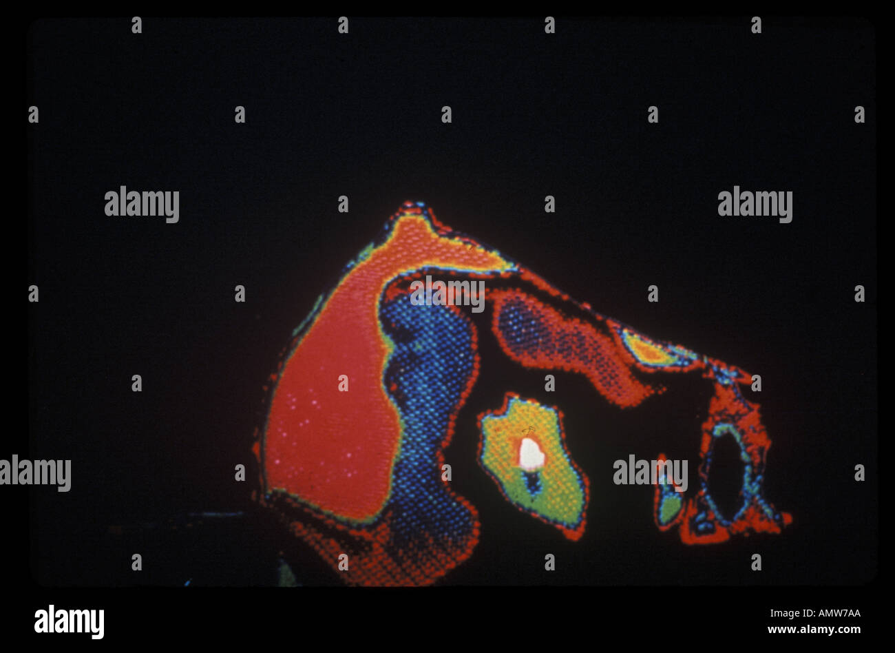 Thermography Breast cancer Stock Photo - Alamy