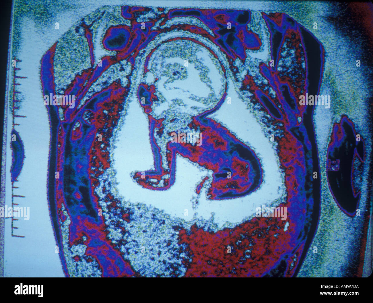 Mri fetus hi-res stock photography and images - Alamy