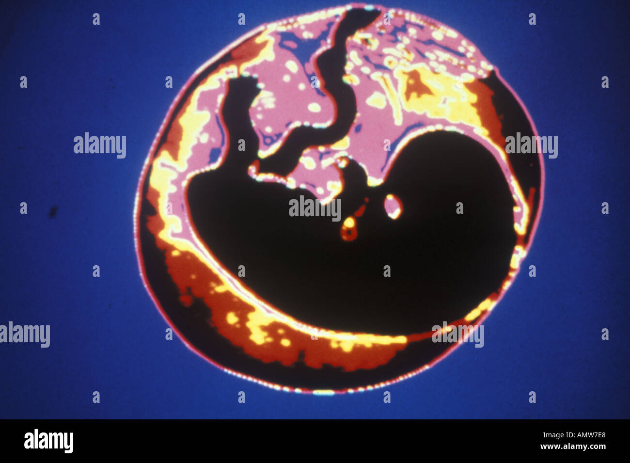 1st trimester Placenta Umbilic Stock Photo - Alamy