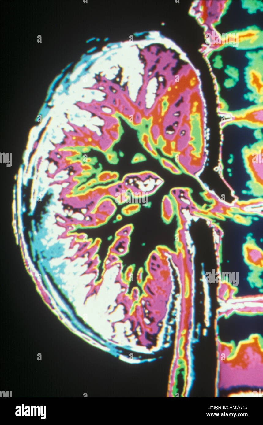 Kidney mri hi-res stock photography and images - Alamy