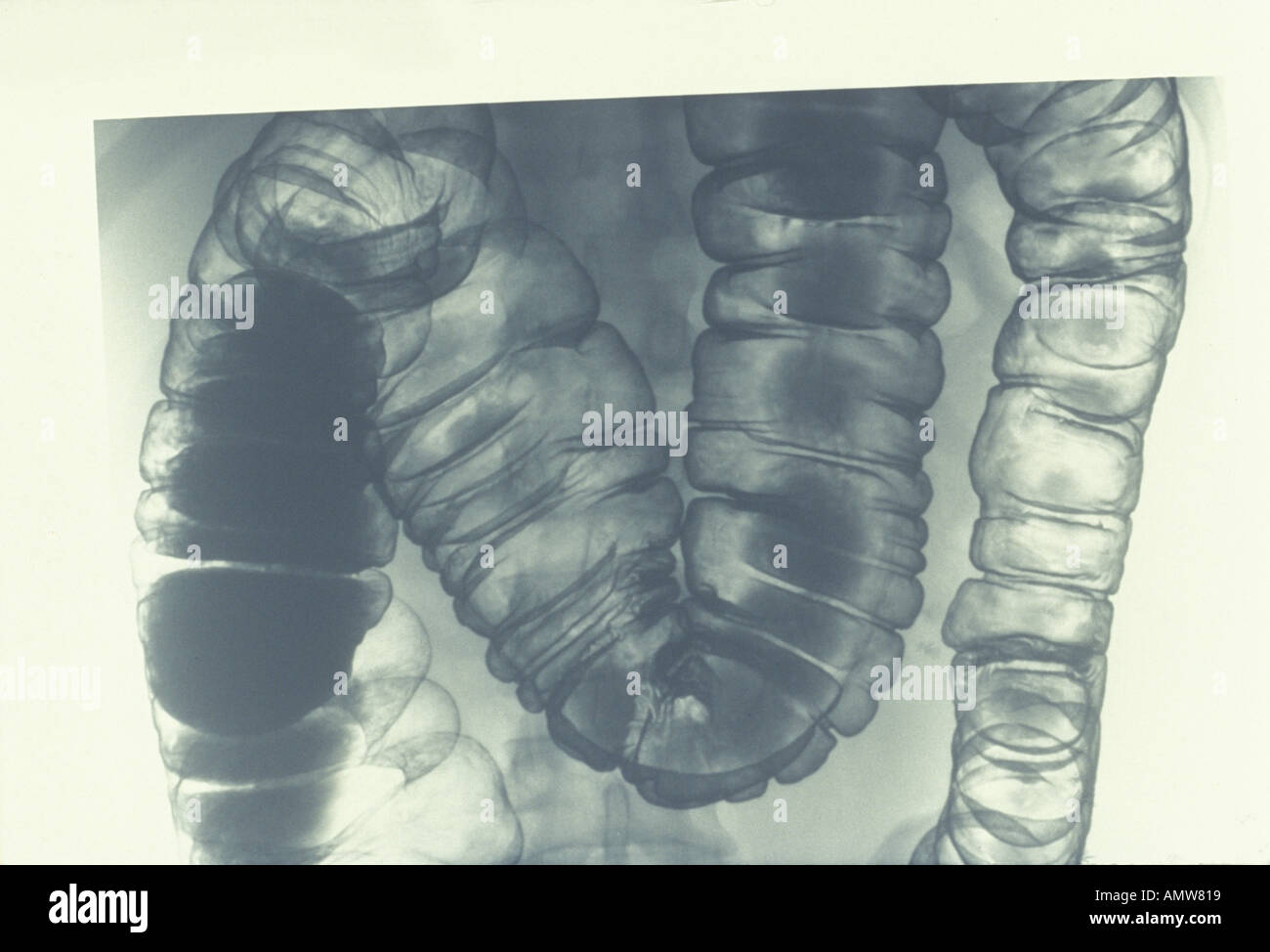 X Ray of intestines Stock Photo - Alamy