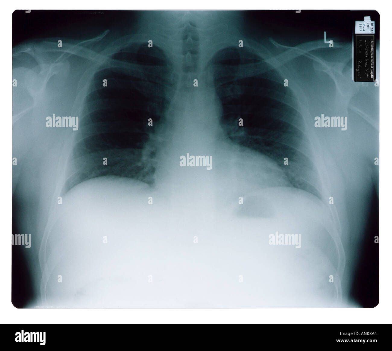 womans chest xray Stock Photo - Alamy