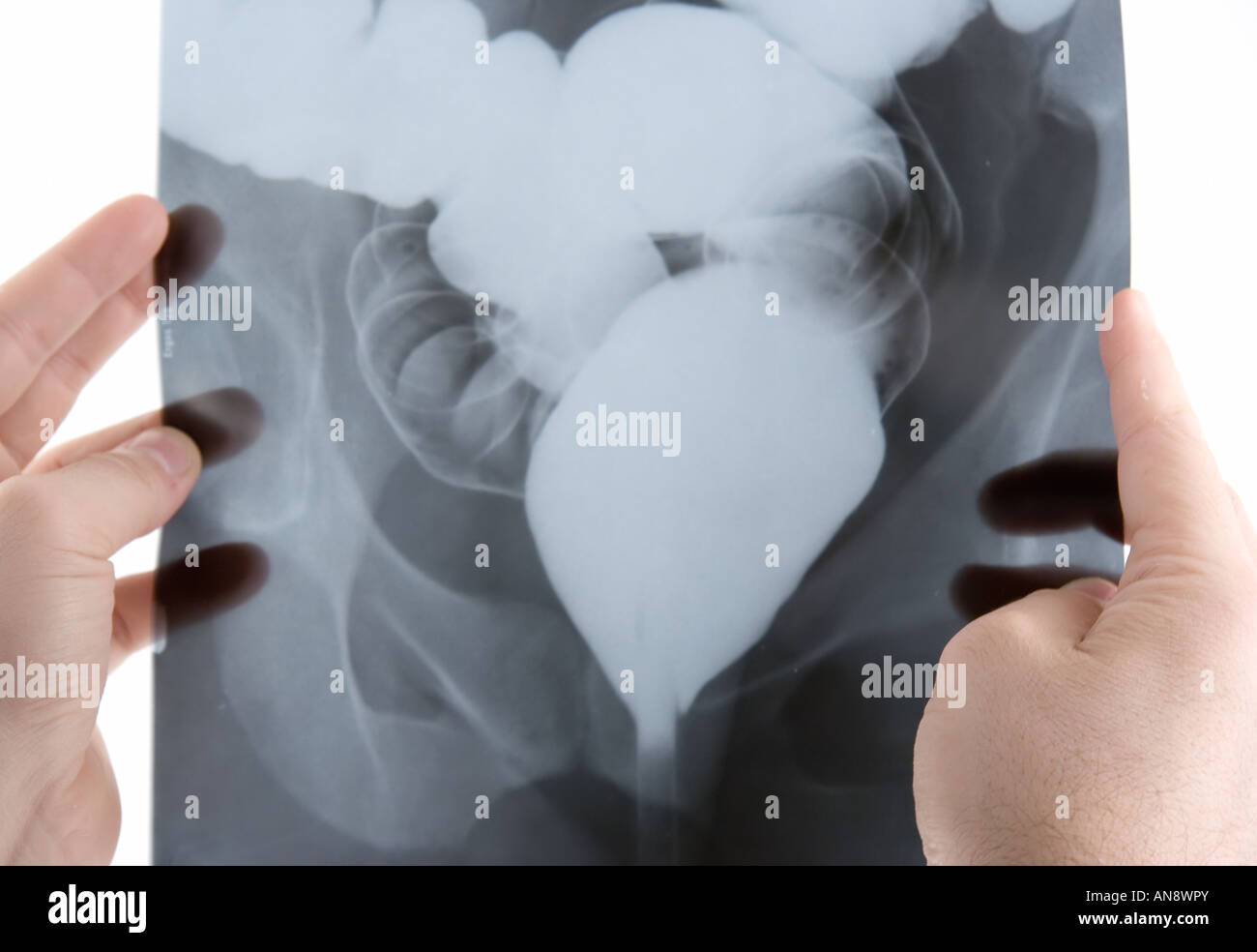 Cancer colon scan hi-res stock photography and images - Alamy