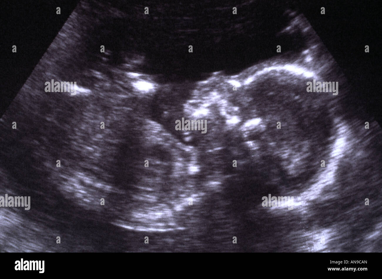 Ultrasound scan image of fetus in mothers womb Stock Photo - Alamy