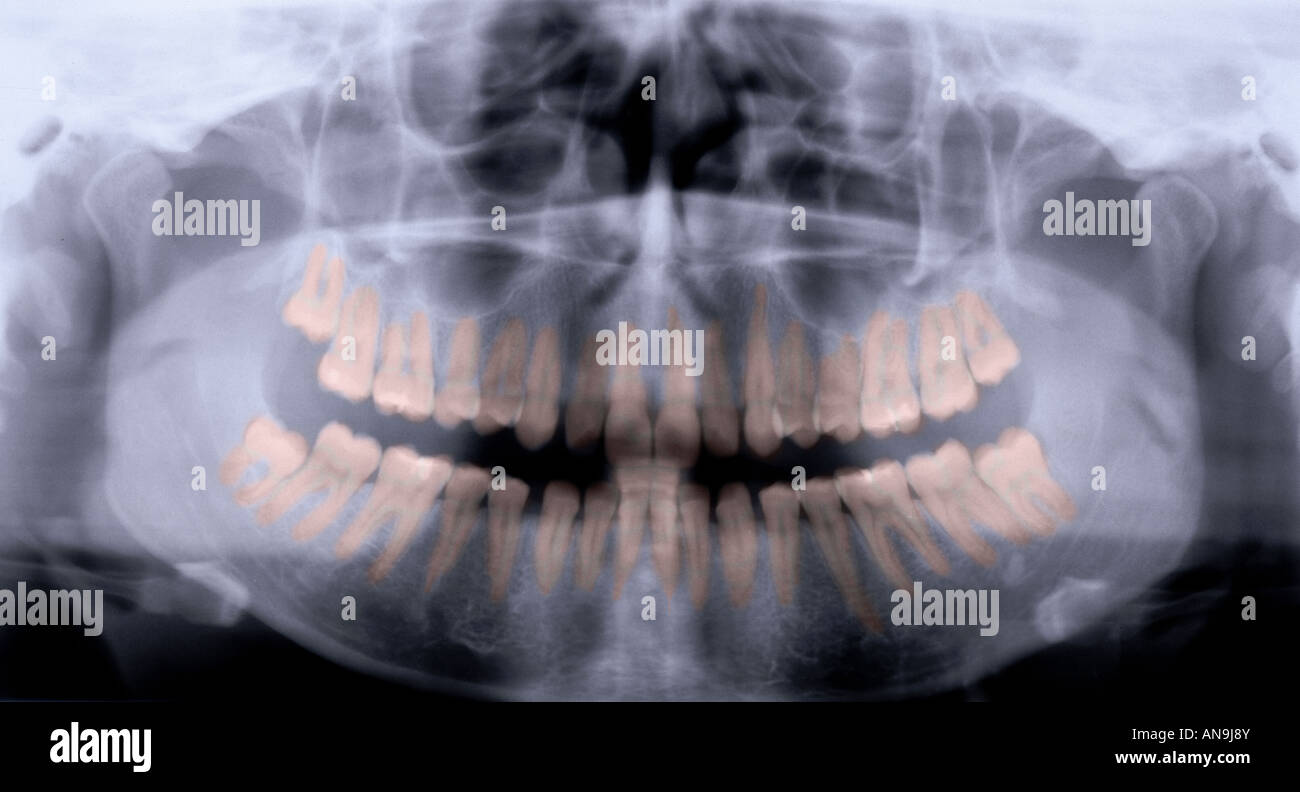 Panoramic X-ray of mouth showing teeth Stock Photo - Alamy