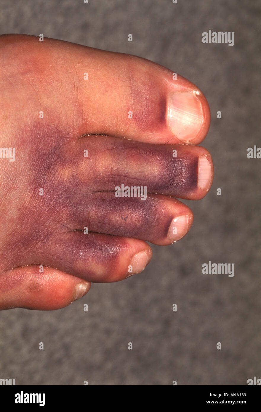 Injured toes discoloured Stock Photo - Alamy