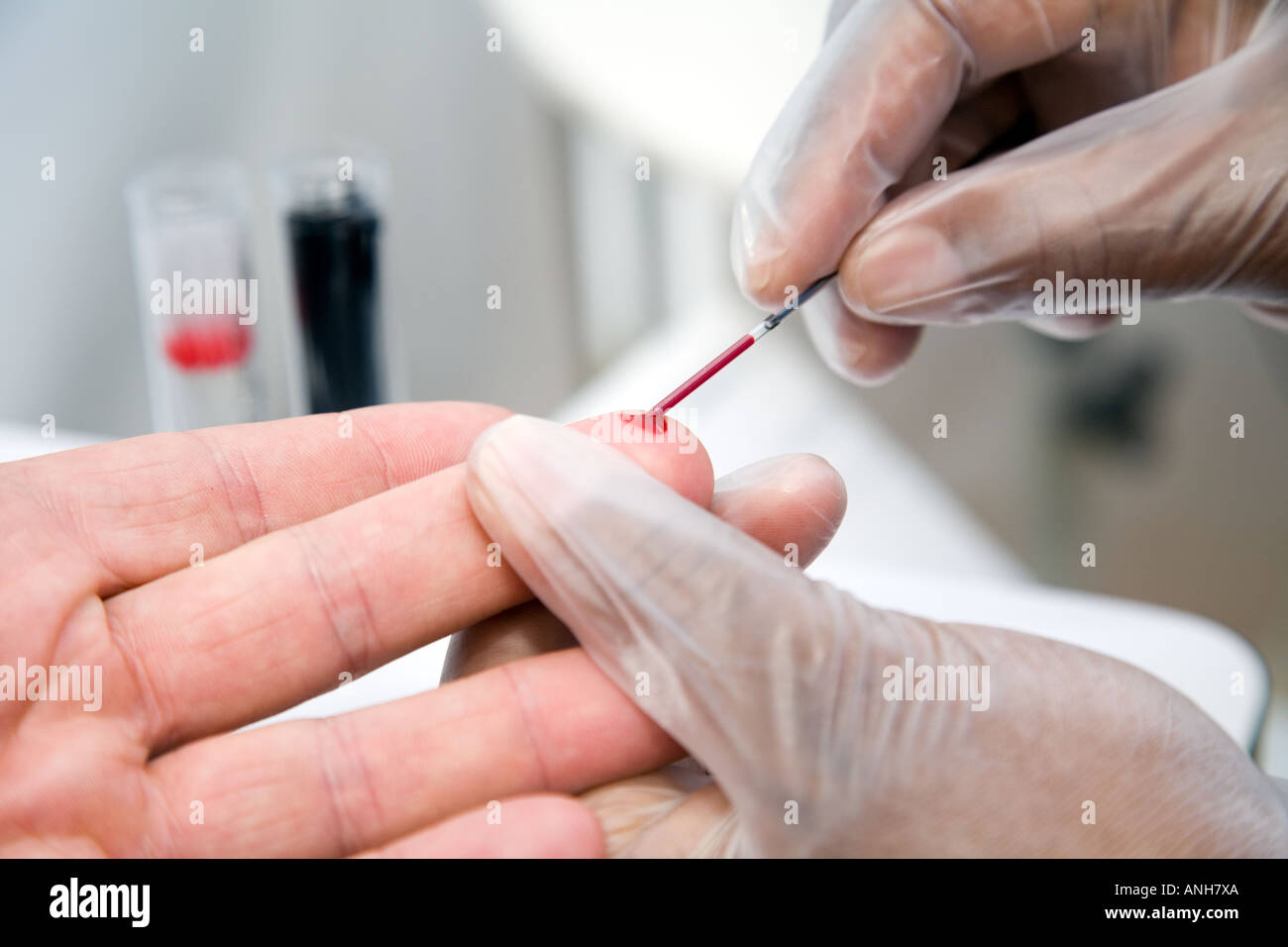 Cholesterol screen testing via blood test Stock Photo - Alamy