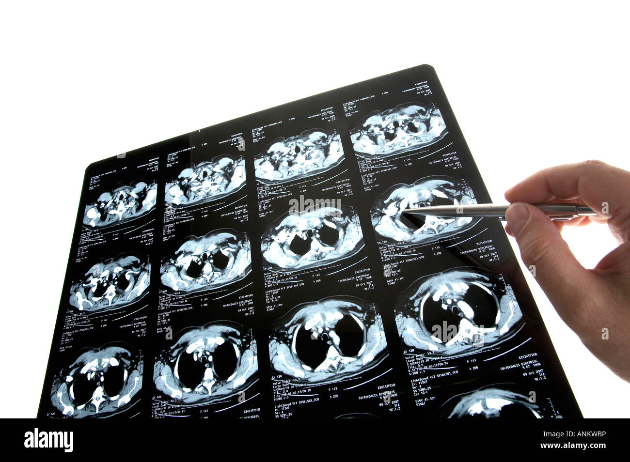 Male hand with pen examining a cat scan Stock Photo - Alamy