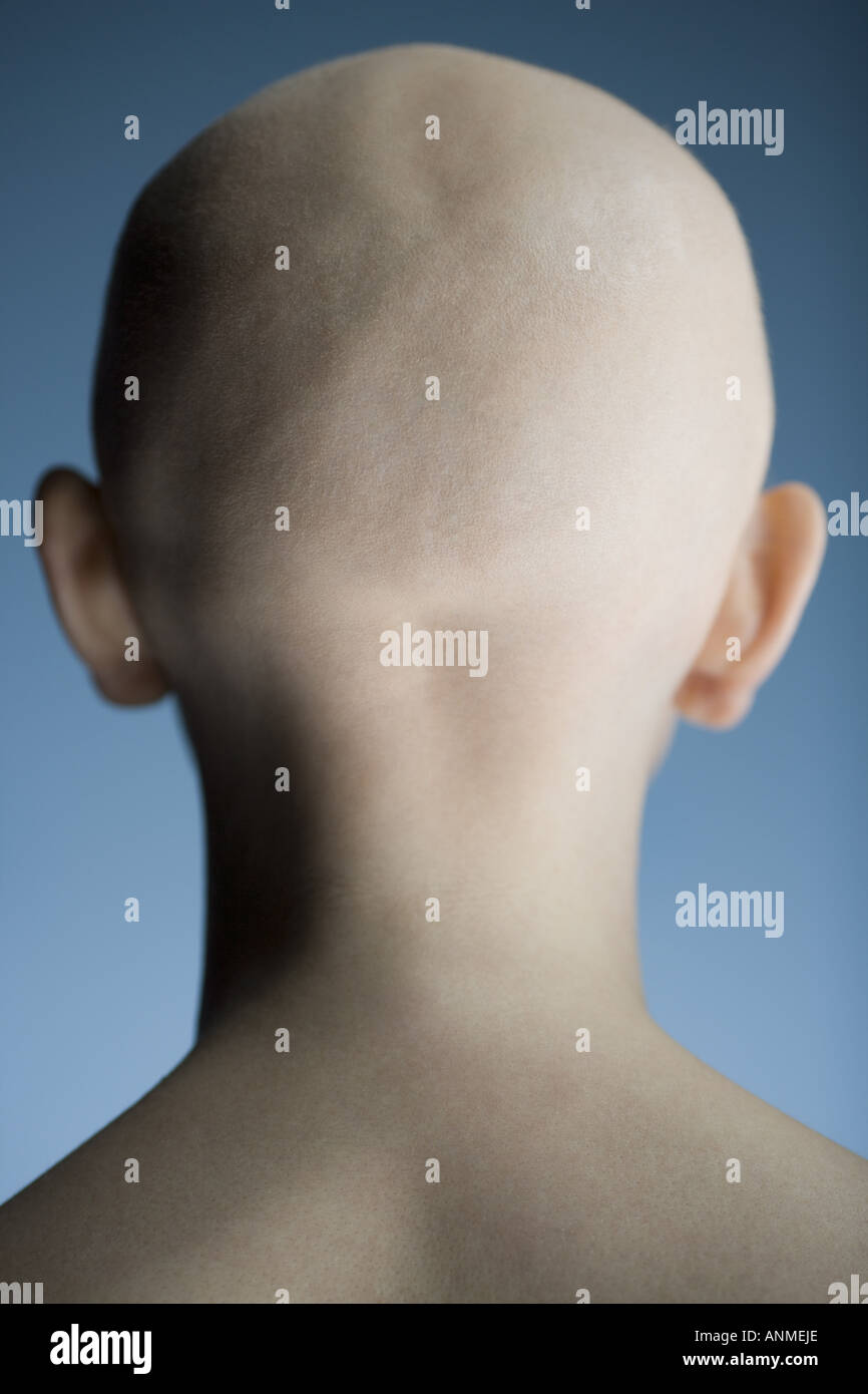 Rear view of a bald young woman Stock Photo - Alamy Rear view of a bald young woman Stock Photo - Alamy