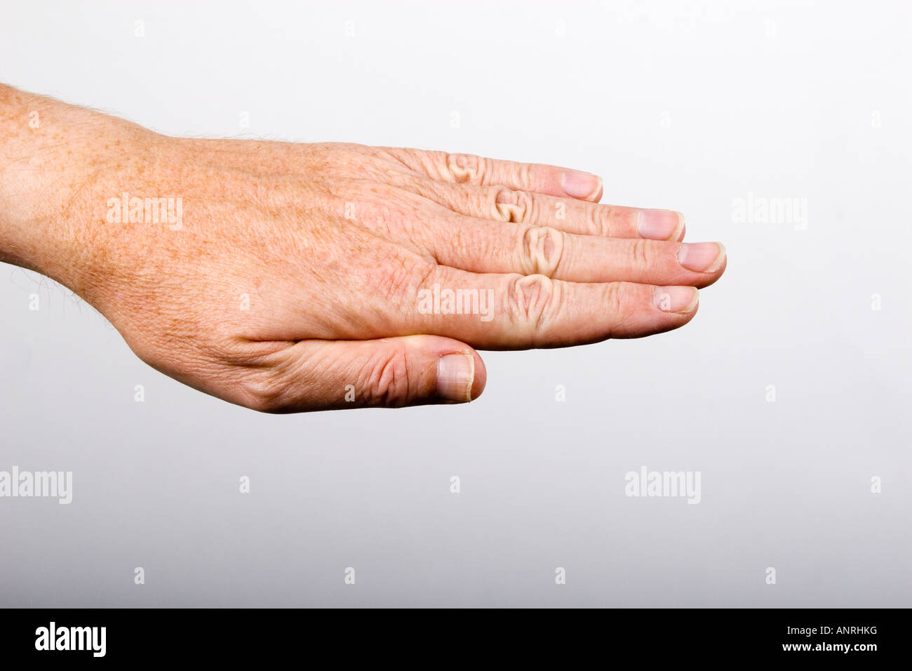 Posture disorders hi-res stock photography and images - Alamy