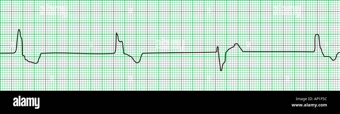 Ekg kurve hi-res stock photography and images - Alamy