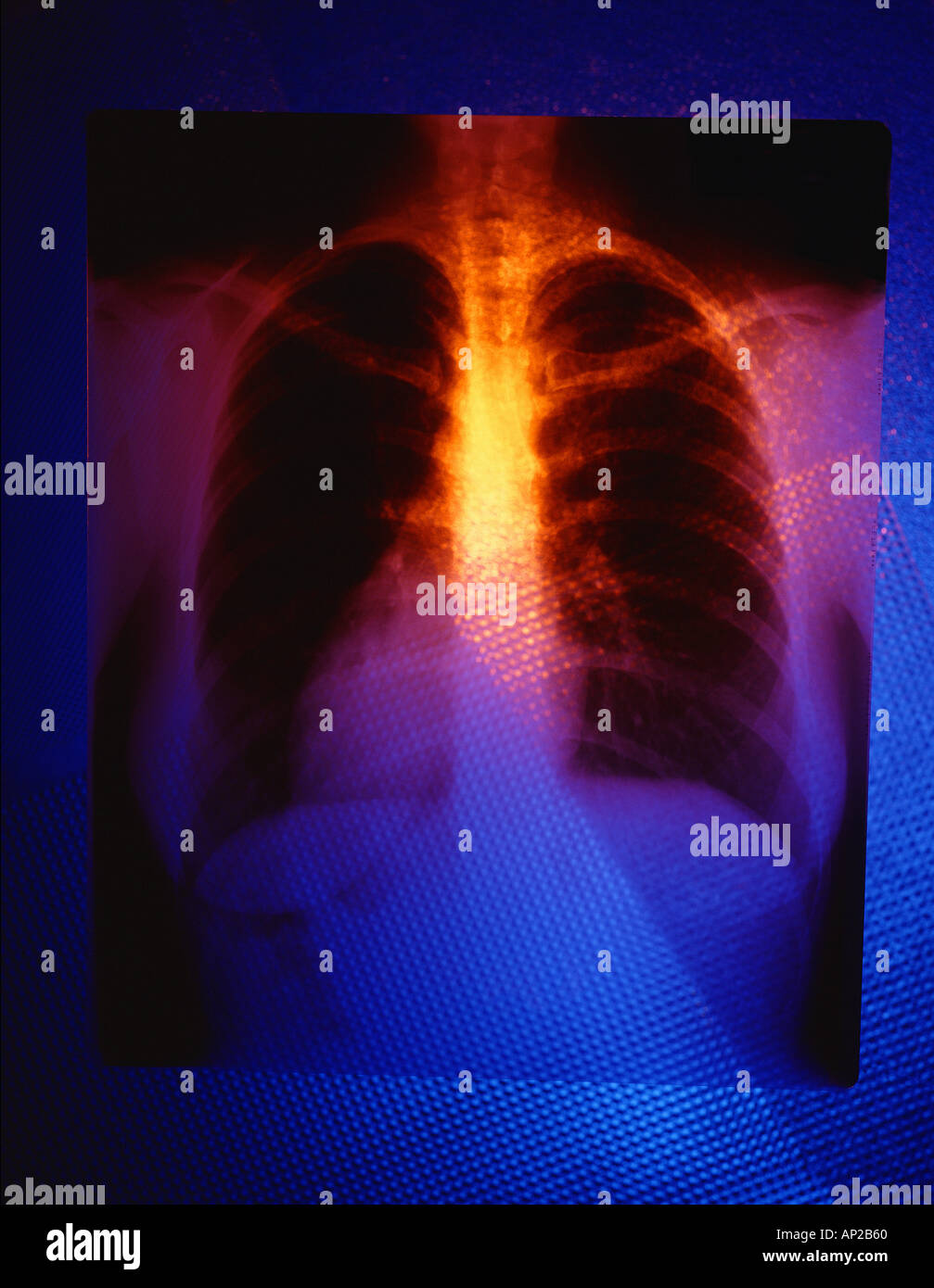 Chest x ray Stock Photo - Alamy