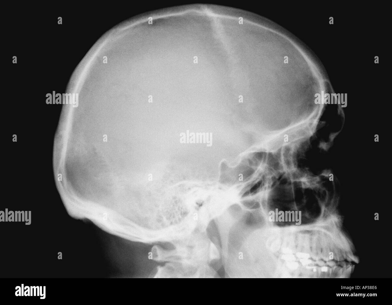 Forensic x ray hi-res stock photography and images - Alamy
