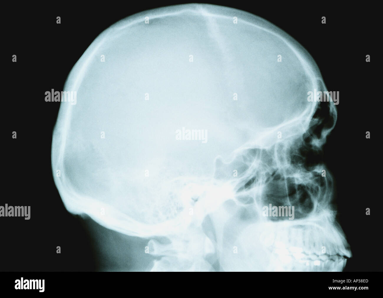 Forensic x ray hi-res stock photography and images - Alamy