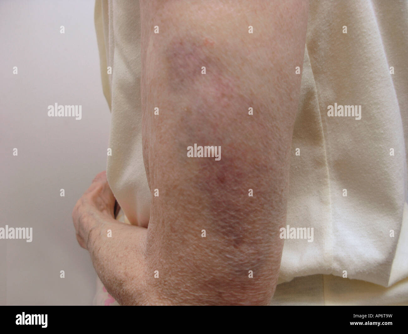 Bruised arm hi-res stock photography and images - Alamy