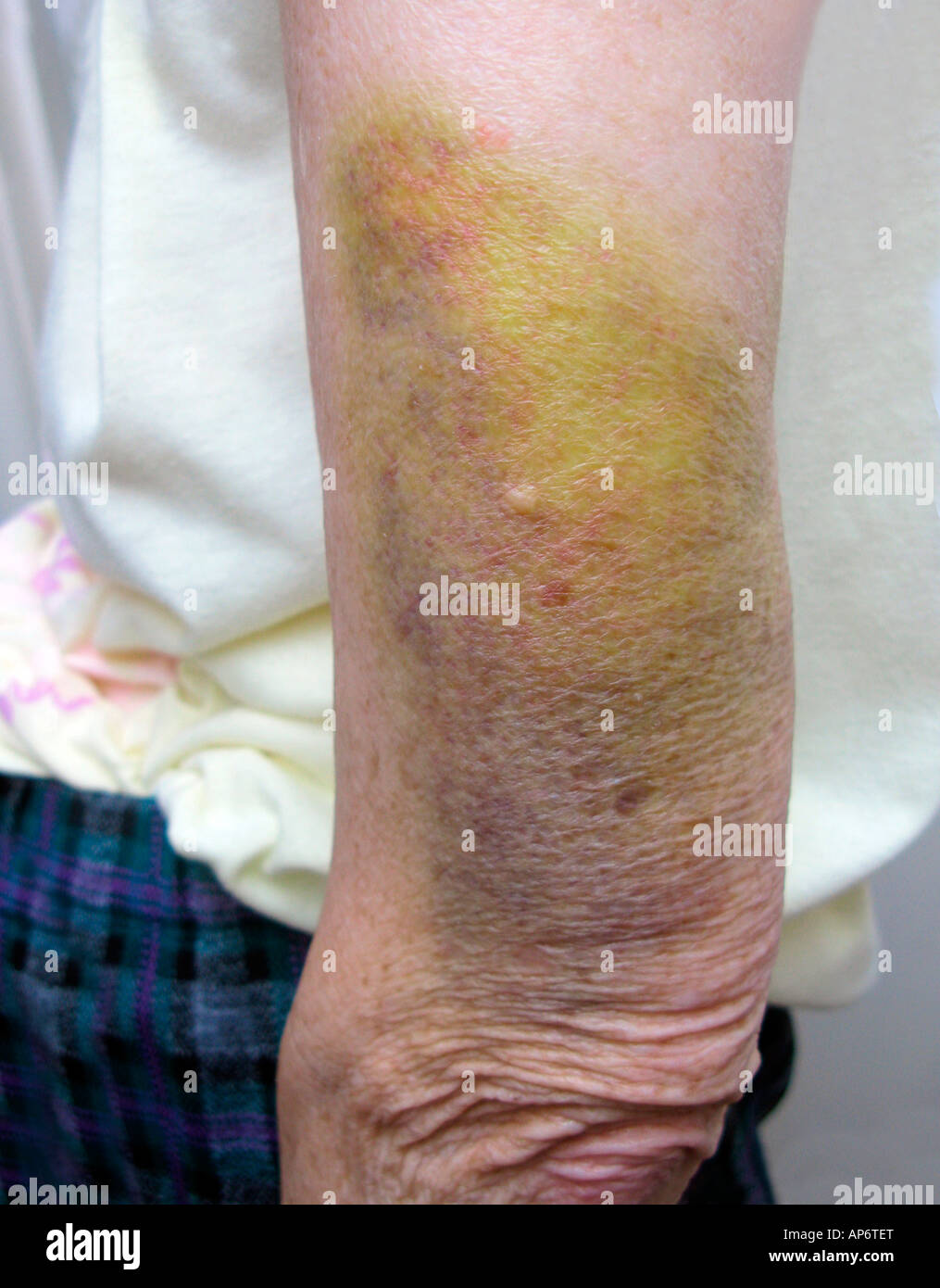 Bruises abuse hi-res stock photography and images - Alamy