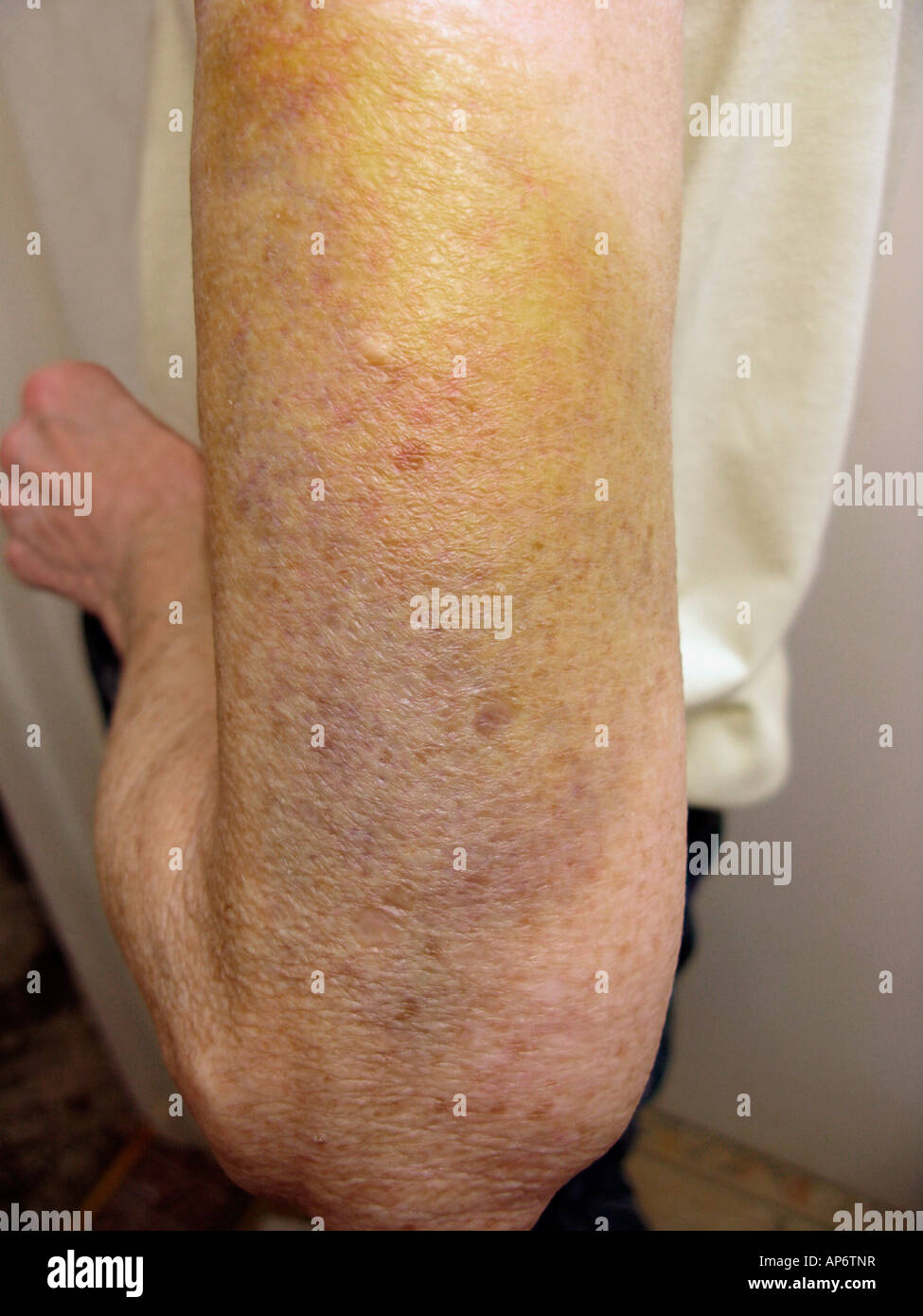 Bruised arm hi-res stock photography and images - Alamy