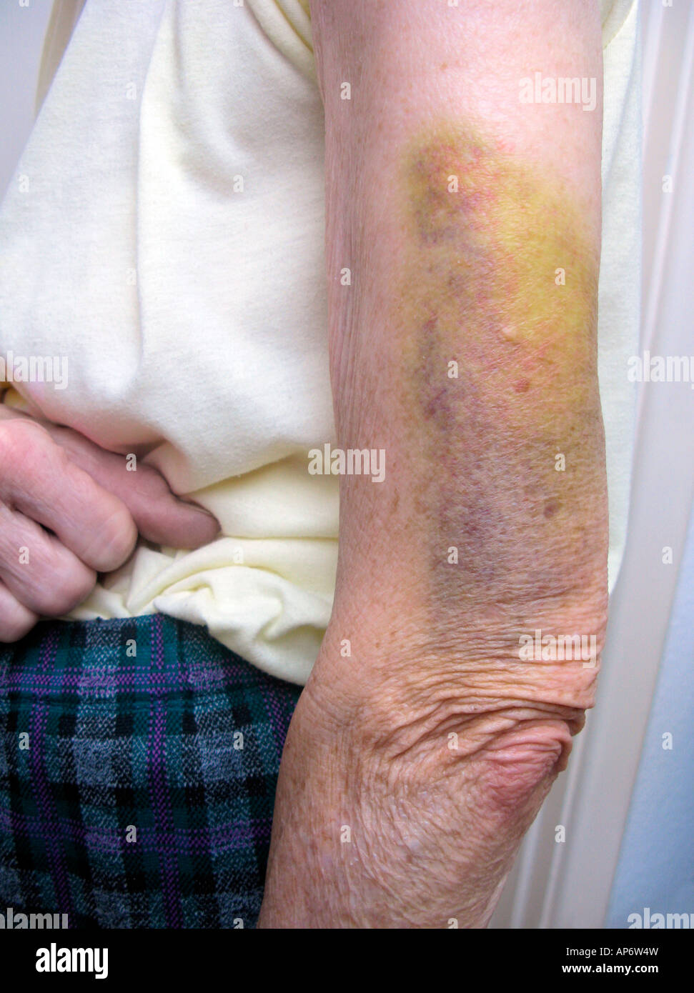 elderly woman with a badly bruised arm Stock Photo - Alamy