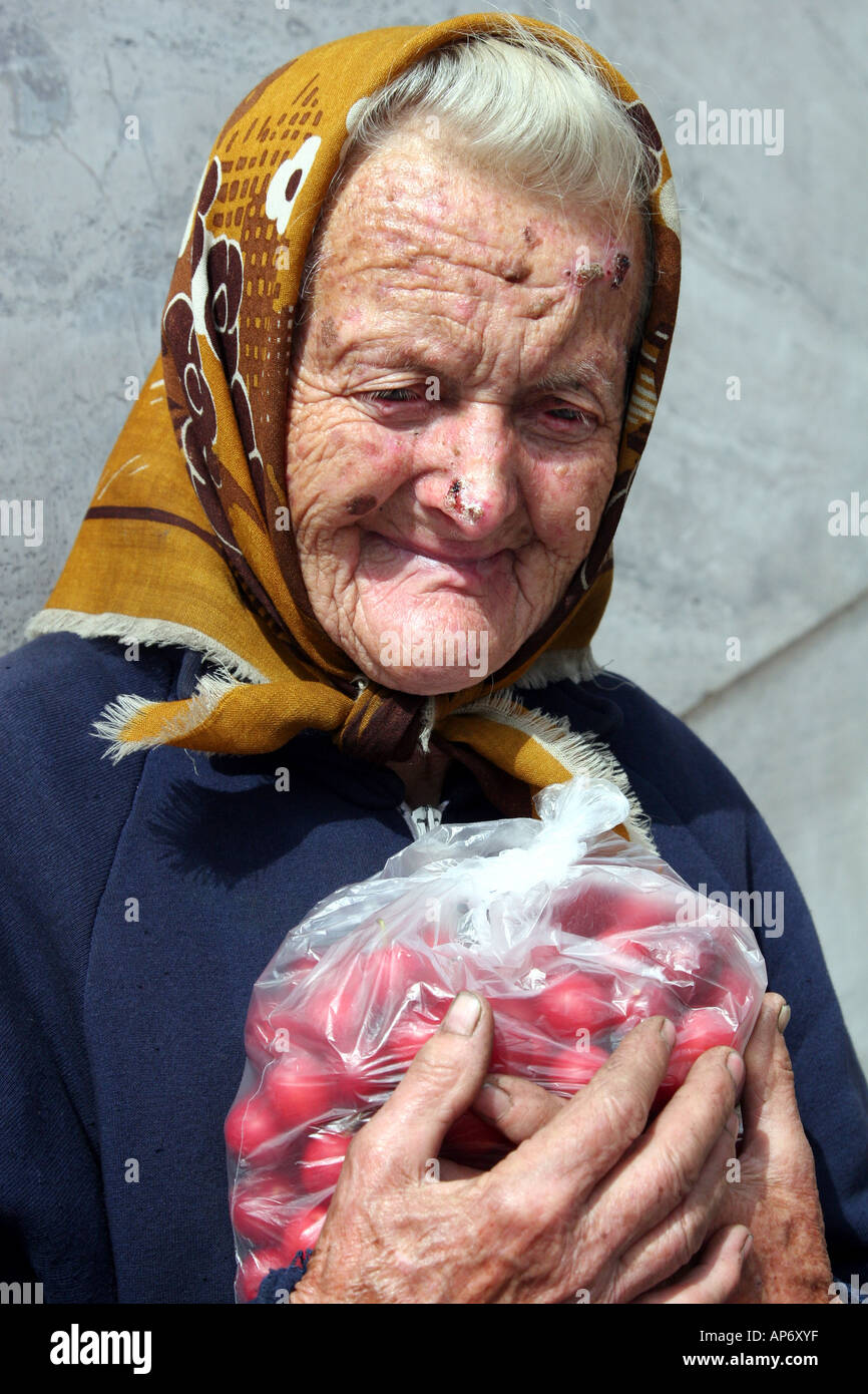 “80 year old Maria Stepanova who has skin cancer” Stock Photo - Alamy