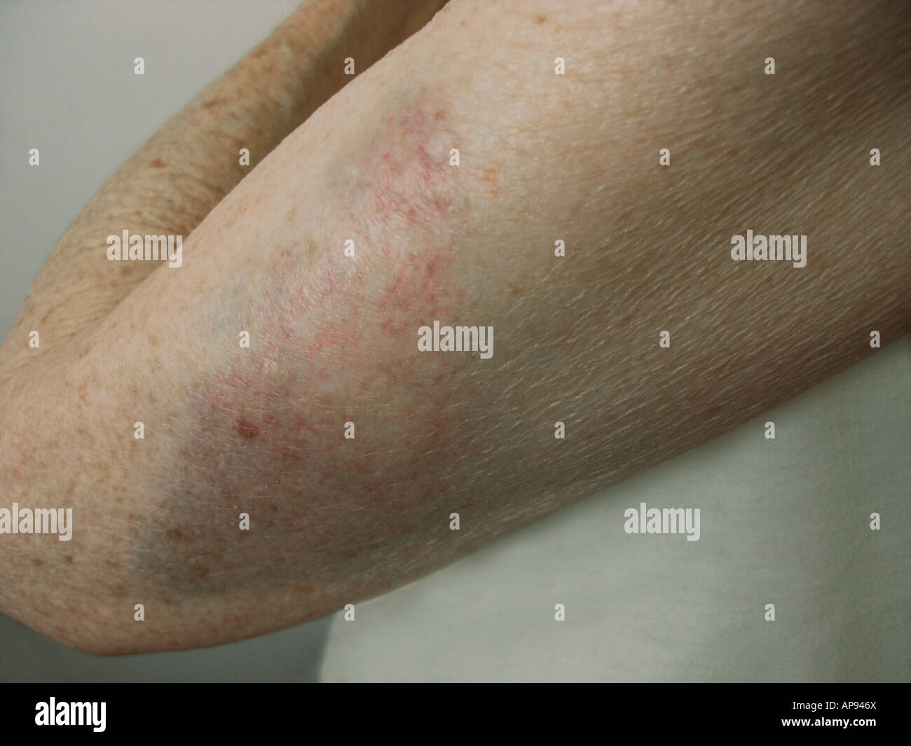Elderly woman badly bruised arm hi-res stock photography and images - Alamy
