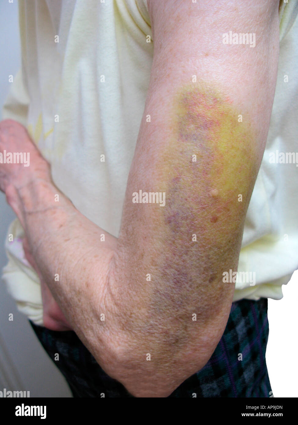 Elderly Abuse Bruises