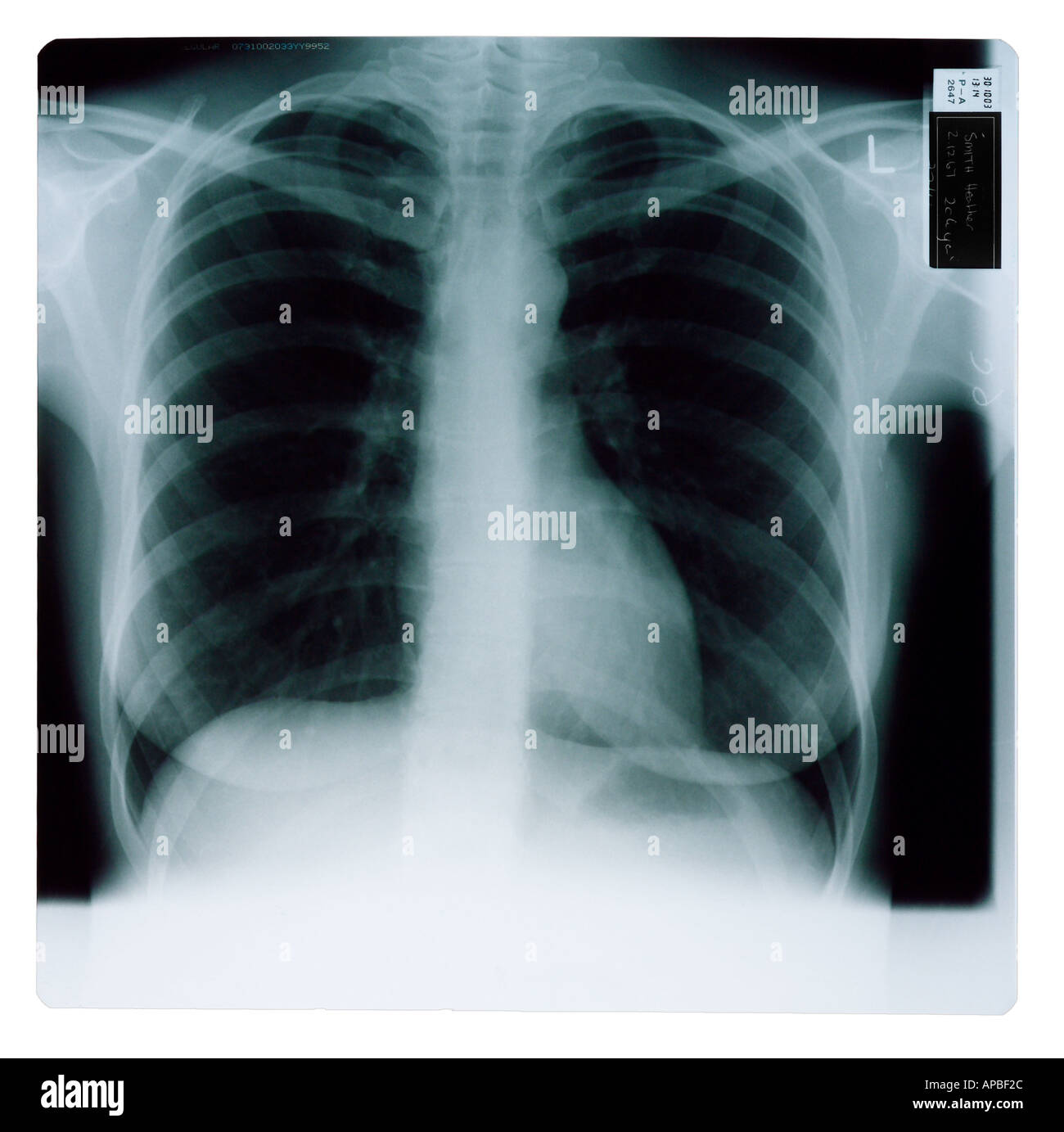 female chest xray Stock Photo - Alamy