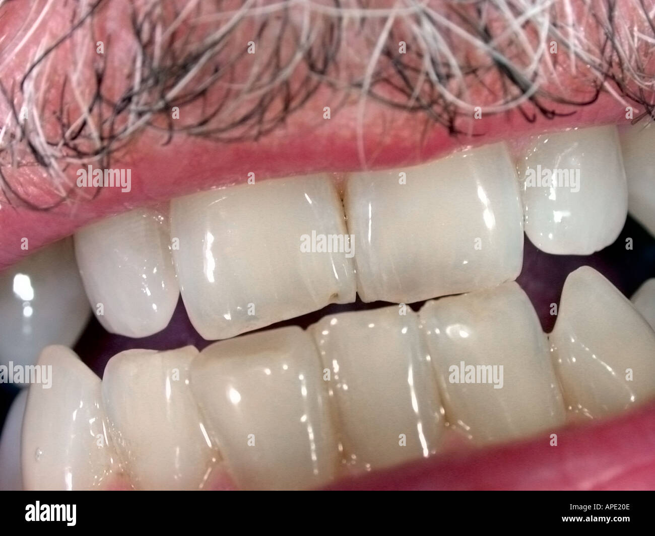 Chipped Teeth Stock Photos & Chipped Teeth Stock Images - Alamy
