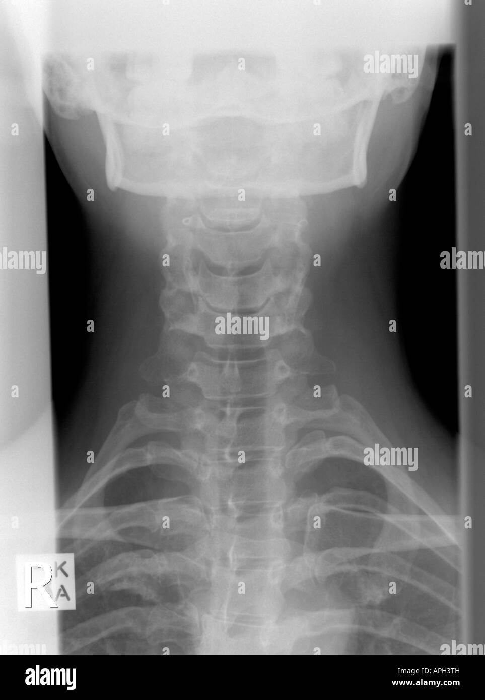 Ap View Cervical Xray Buyxraysonline