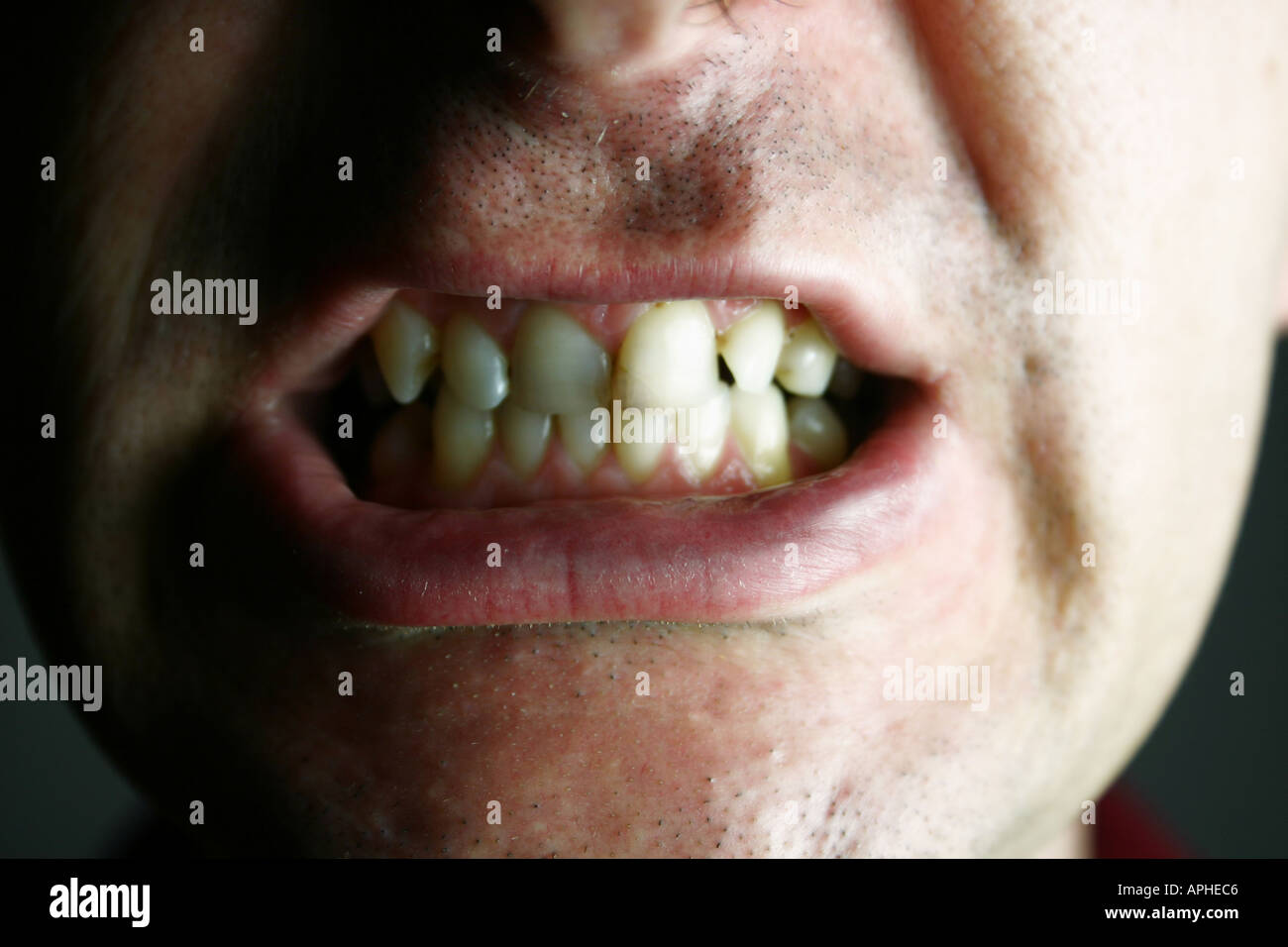 Retarted People With Bad Teeth