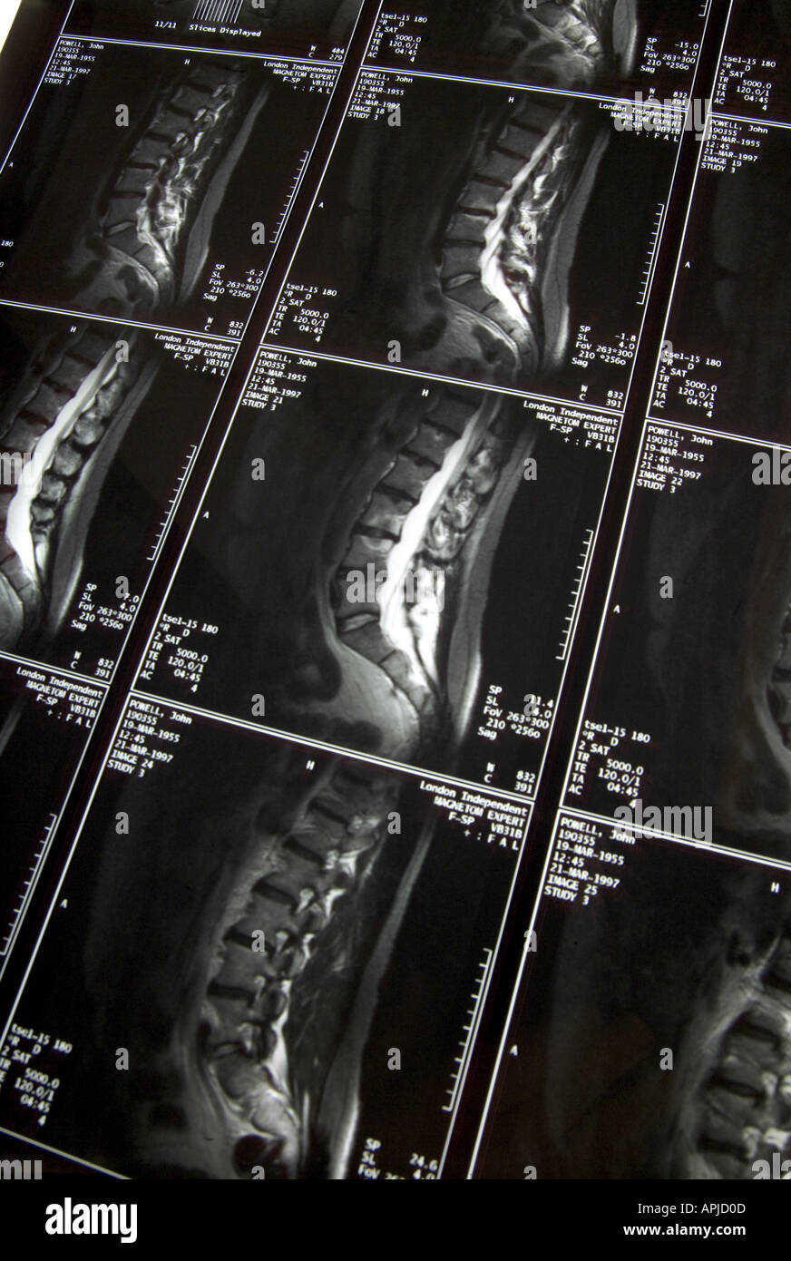 Mri sacrum hi-res stock photography and images - Alamy