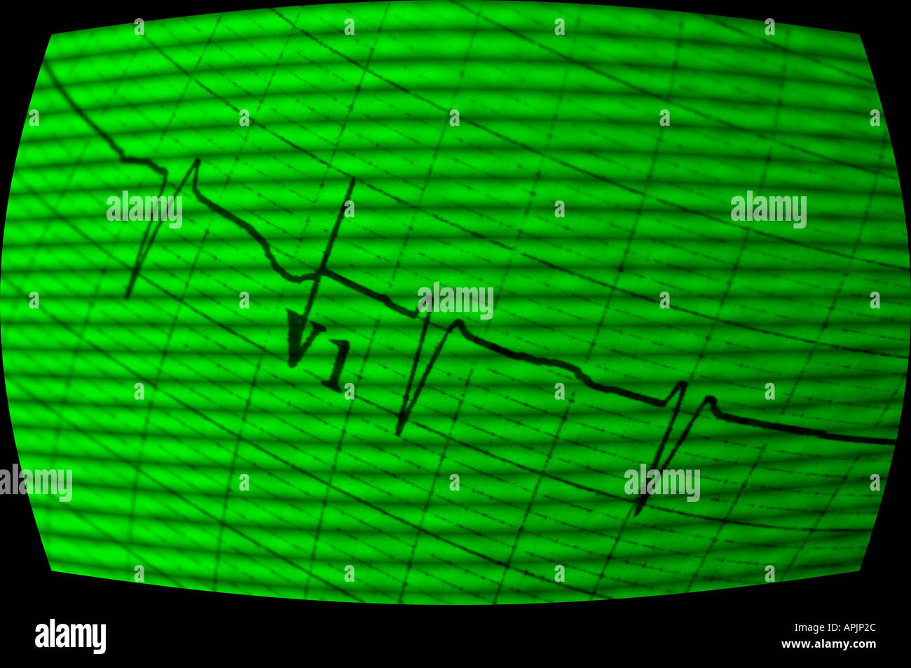 EKG on closed circuit monitor in hospital Stock Photo - Alamy