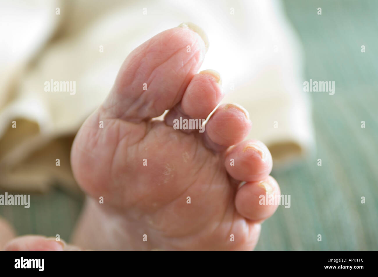 foot of 80-year-old woman with overgrown toenails closeup Stock Photo ...