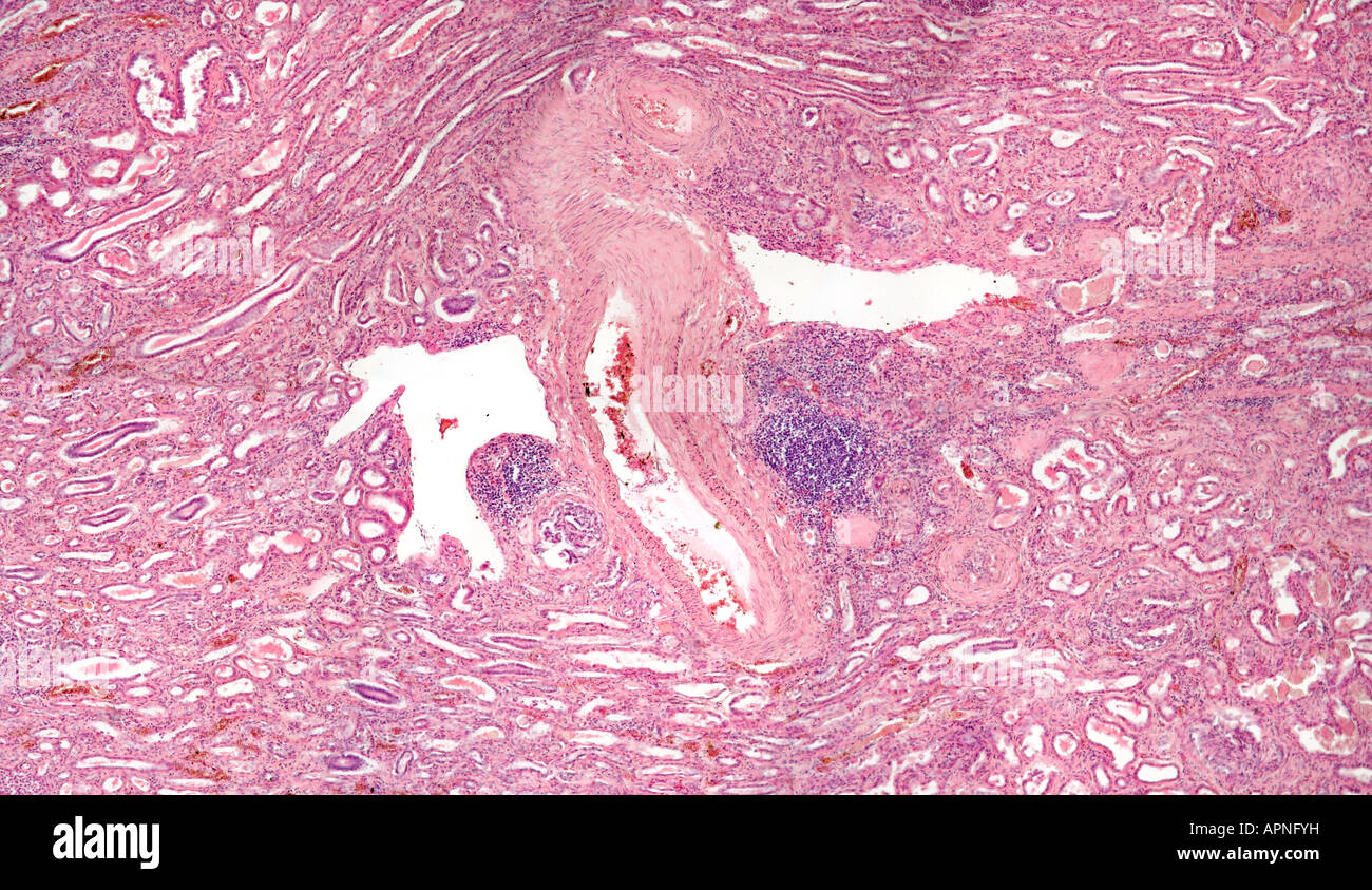 chronic nephritis T S histology section photomicrograph Stock Photo - Alamy