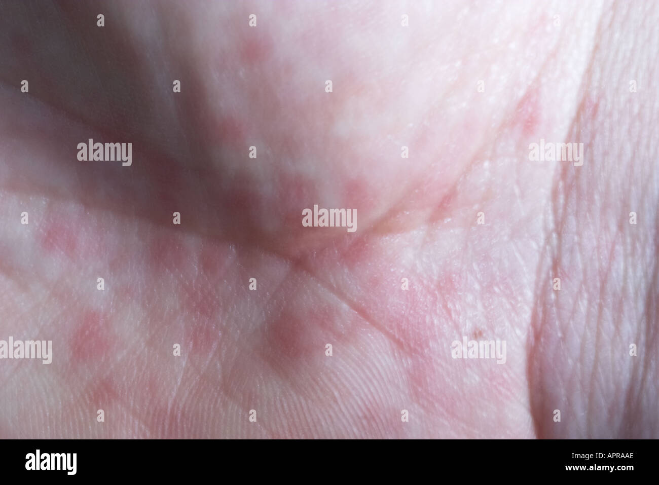 Nettle rash hi-res stock photography and images - Alamy