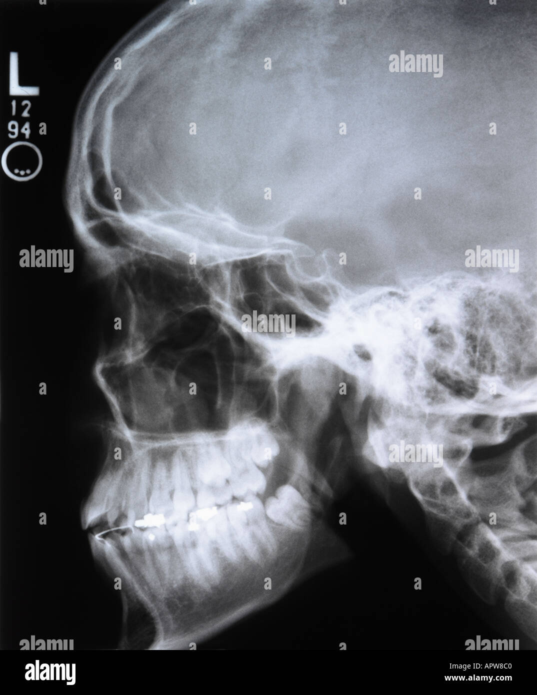 Skull fracture xray hi-res stock photography and images - Alamy