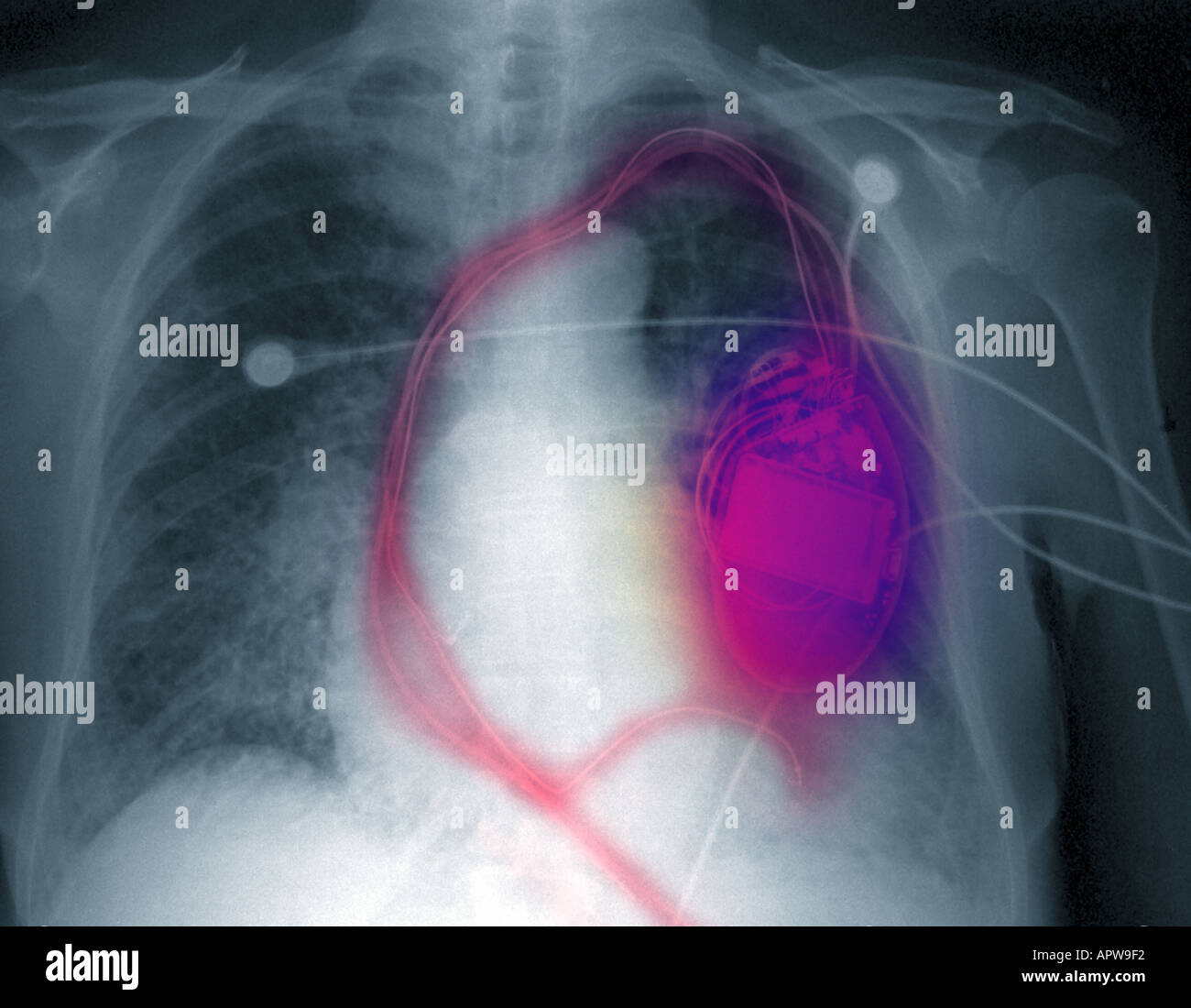chest xray showing cardiac pacer defibrillator Stock Photo - Alamy