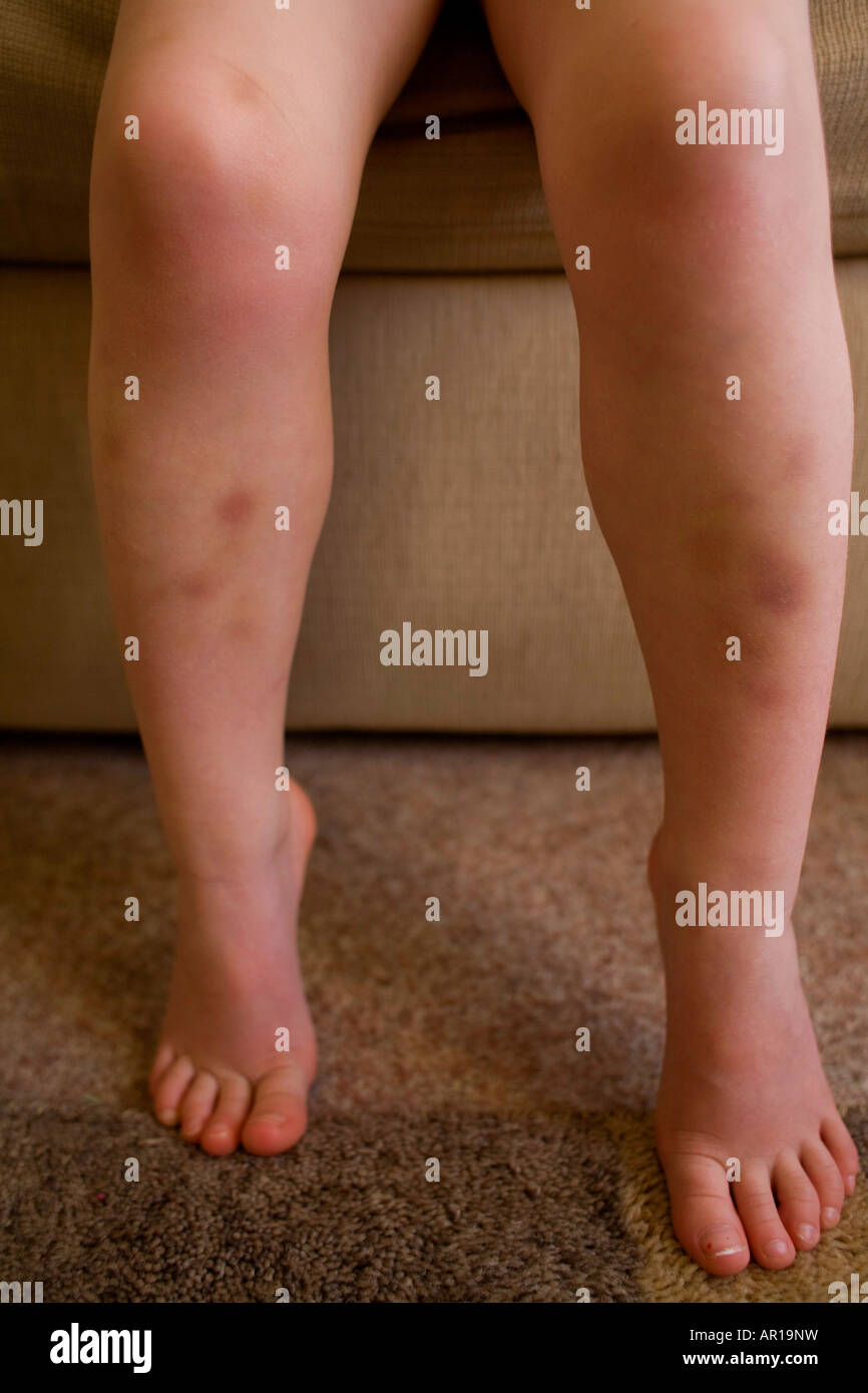 Leg Bruises