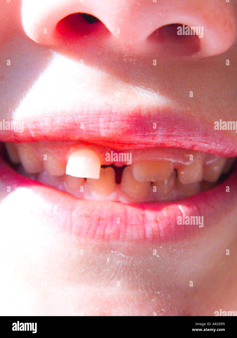 loose tooth grin Stock Photo - Alamy