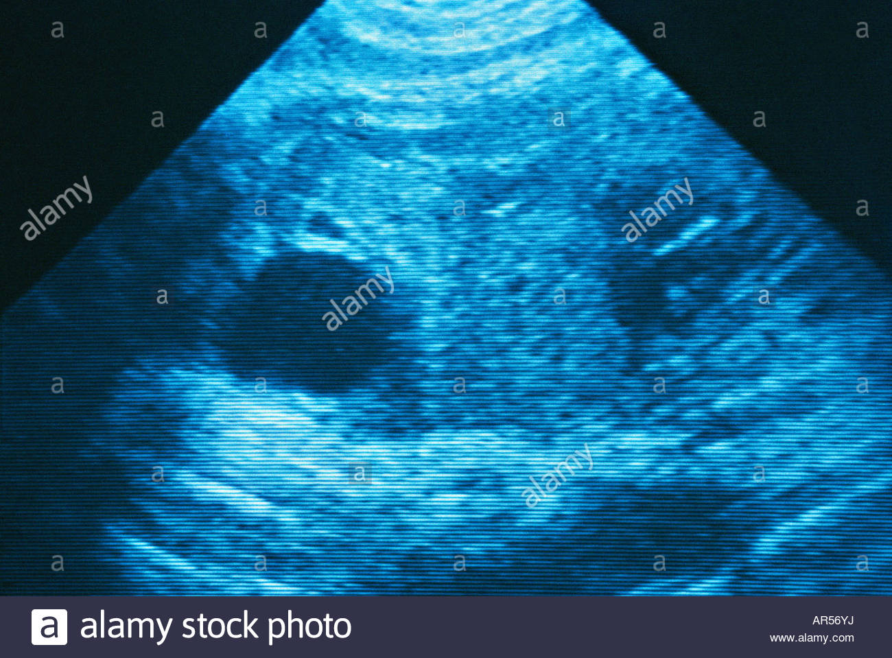 Foetal Stock Photos & Foetal Stock Images - Alamy