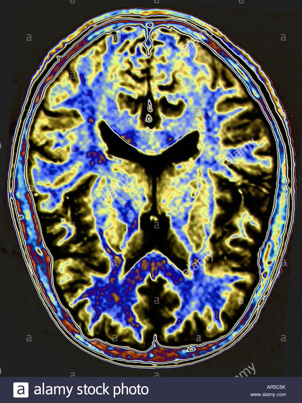 Brain Tumor Scan Stock Photos & Brain Tumor Scan Stock Images - Alamy