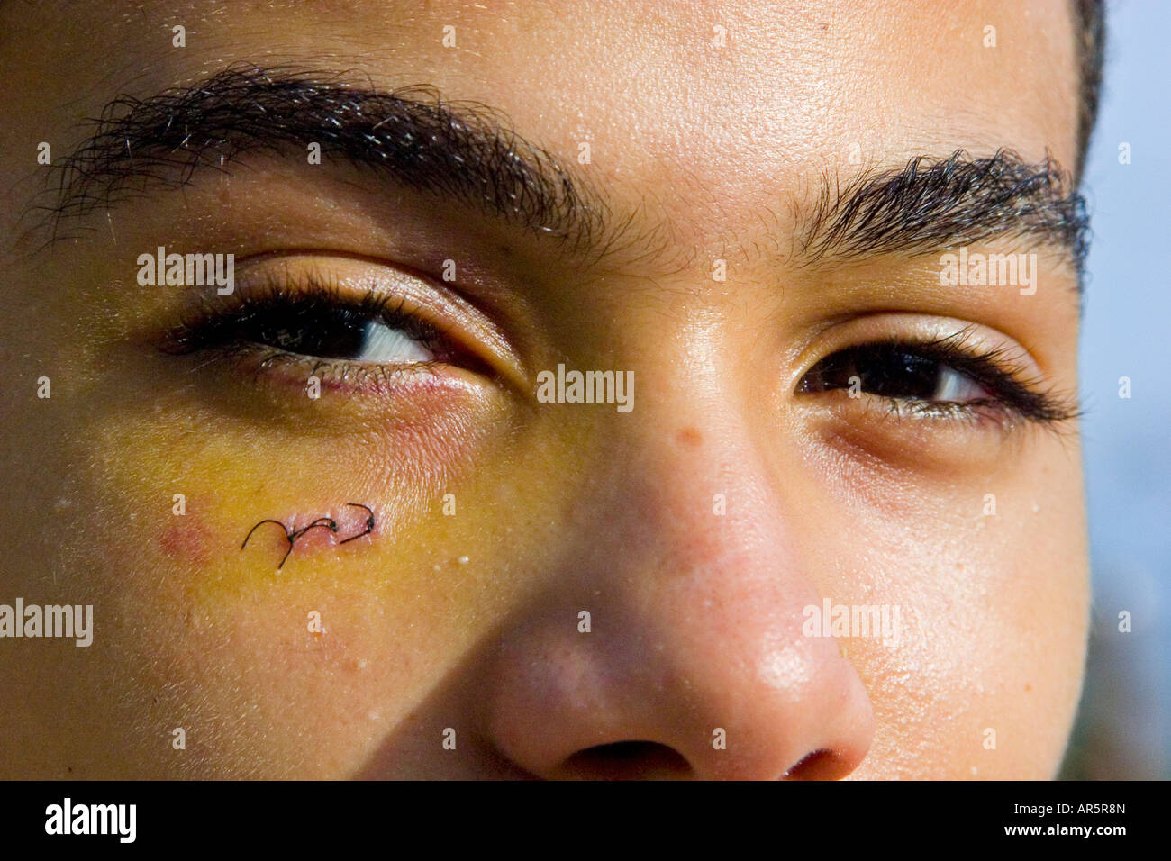 A young boy with a scar in his face memory of the fight Stock Photo - Alamy