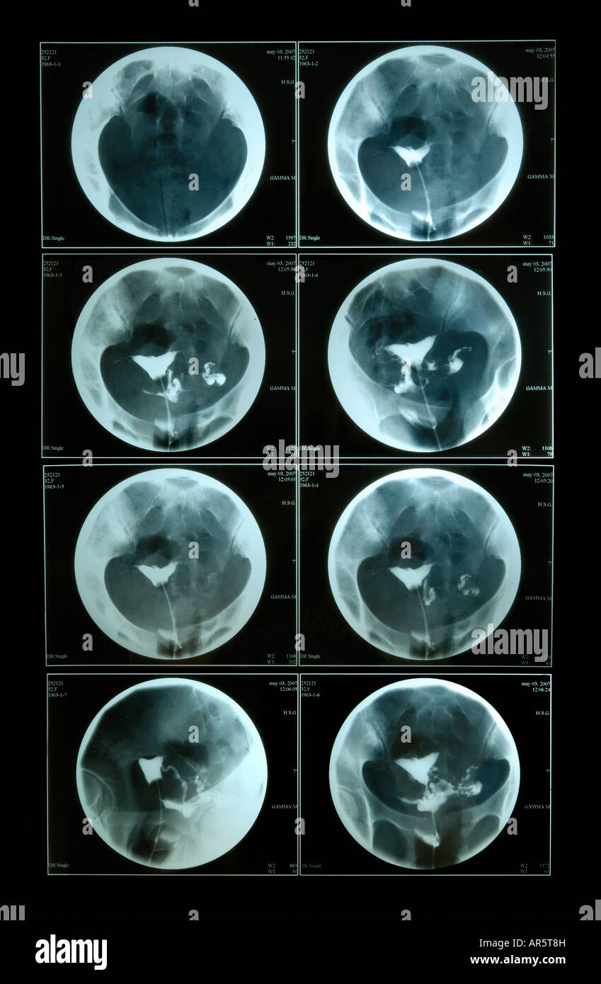 Hysterosalpingogram uterus hi-res stock photography and images - Alamy