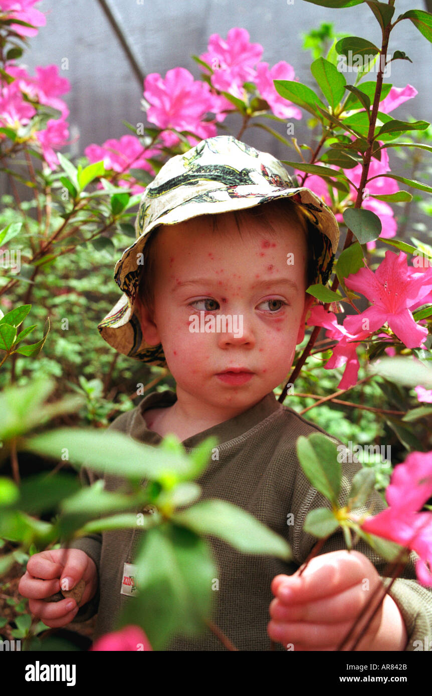 Young child with bad case of Chickenpox Stock Photo - Alamy
